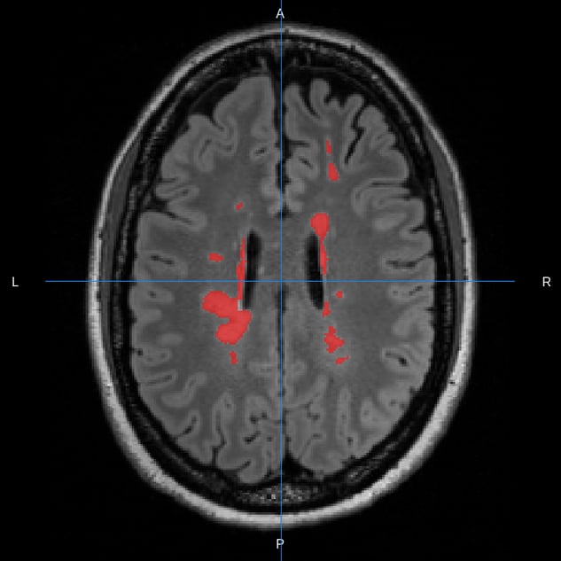 Lesion Segmentation Tool (LPA)