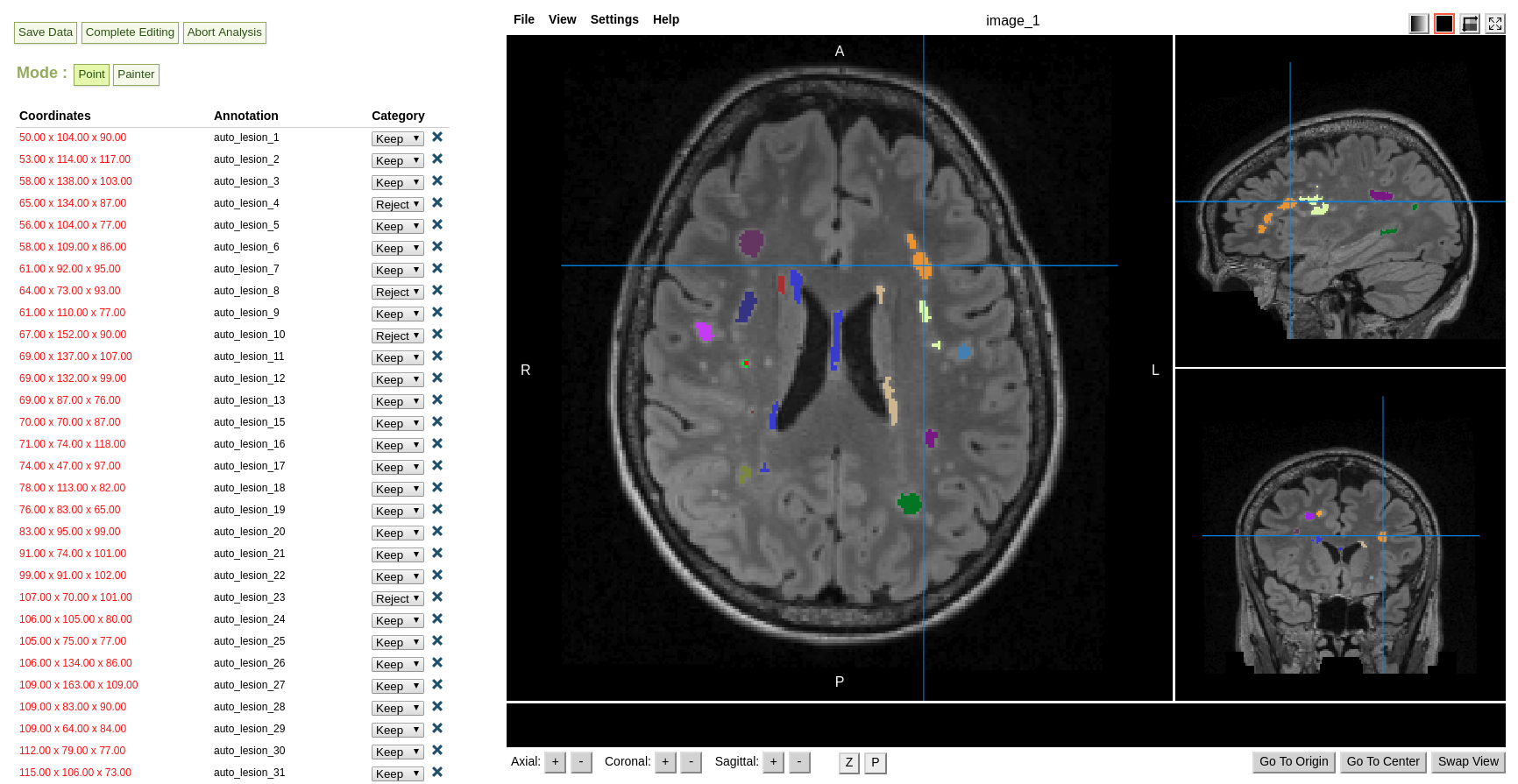 Assisted false-positive rejection for lesion segmentation workflows